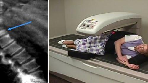 New IOF position paper urges routine use of DXA-VFA in fracture liaison ...