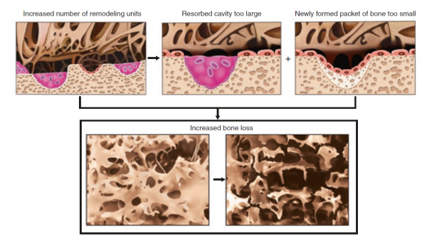 Pathophysiology | International Osteoporosis Foundation