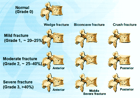 Vertebral fractures | International Osteoporosis Foundation